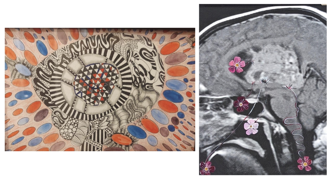 Arizona Artist Discovers the Art of Healing After Brain Tumor Surgery ...